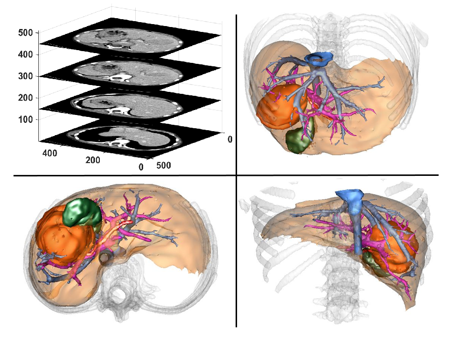Clinical decision system development for paediatric liver tumour surgery